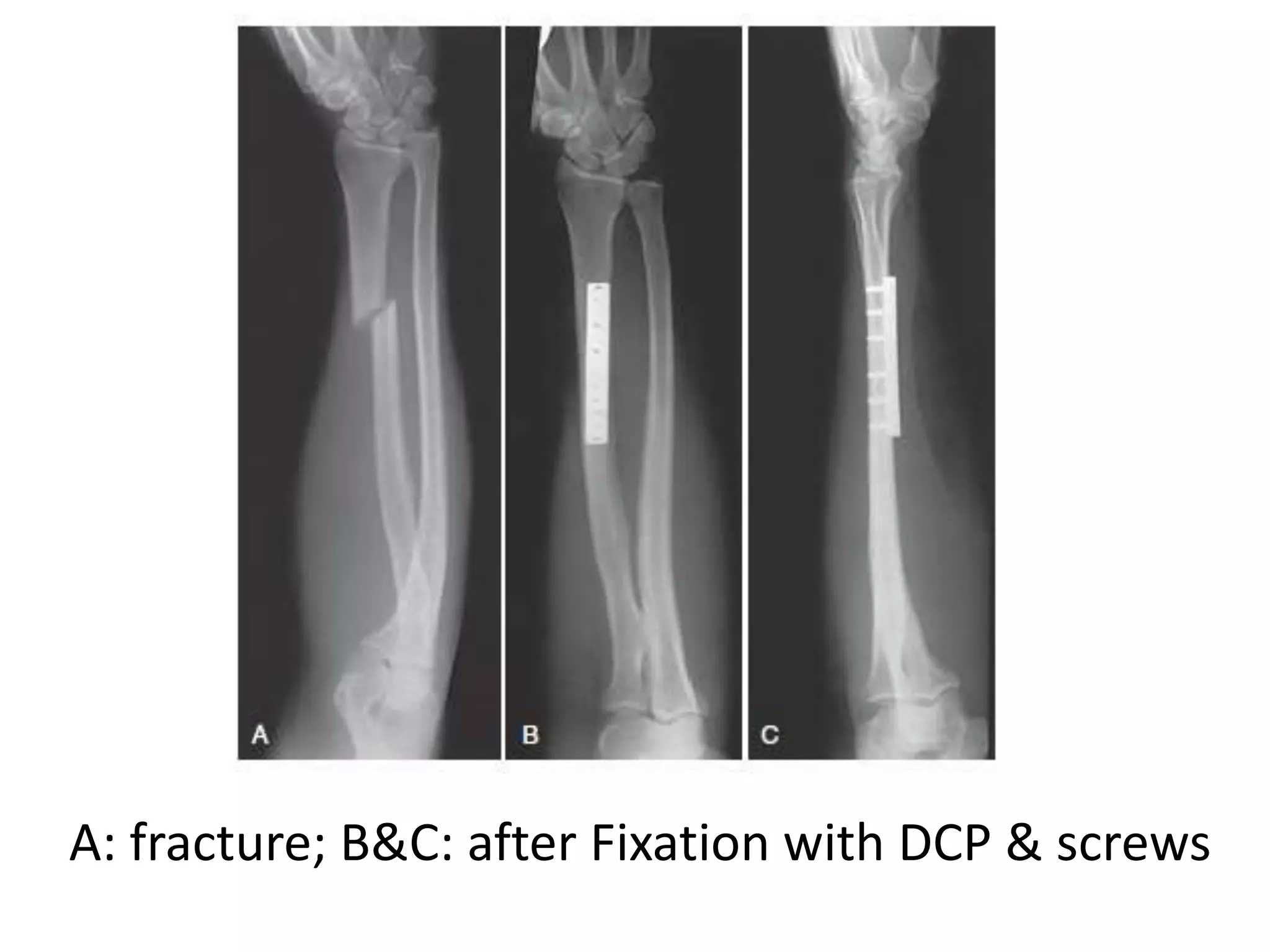 Galeazzi fracture dislocation | PPTX