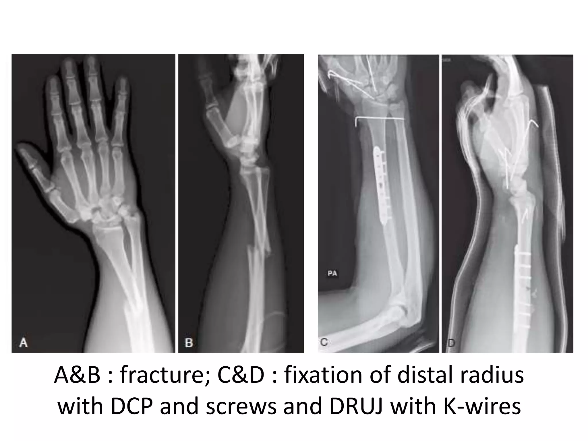 Galeazzi Fracture Dislocation PPTX galeazzi-fracture-dislocation-pptx