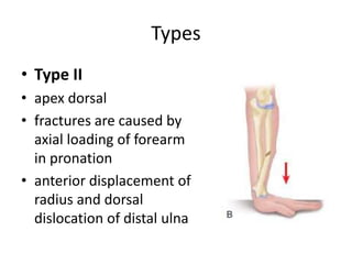 Galeazzi Fracture Classification