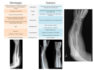 Galeazzi Fracture Vs Monteggia