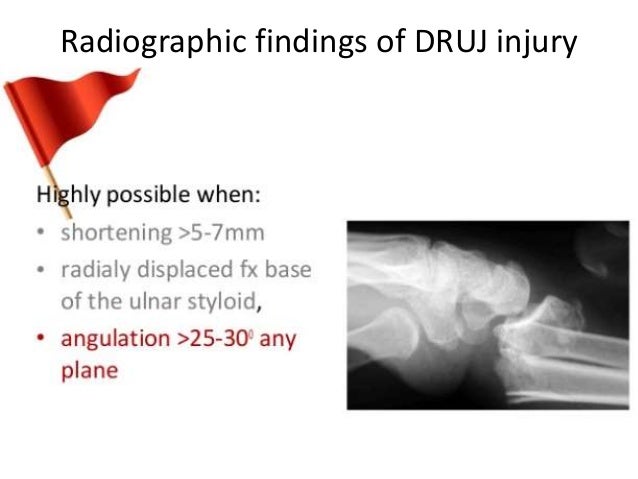 Ao classification of galeazzi fracture - filnlime