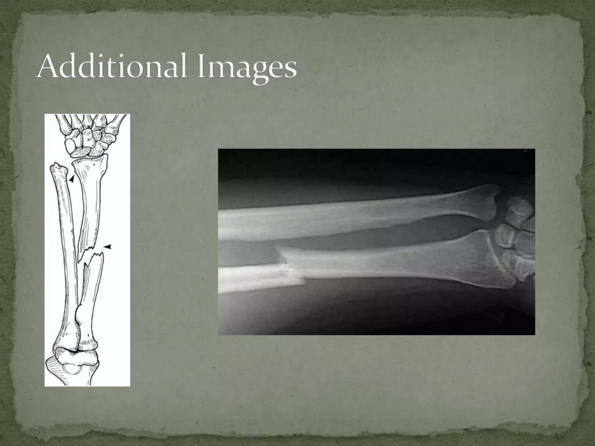 Galeazzi fracture (1) | PPTX