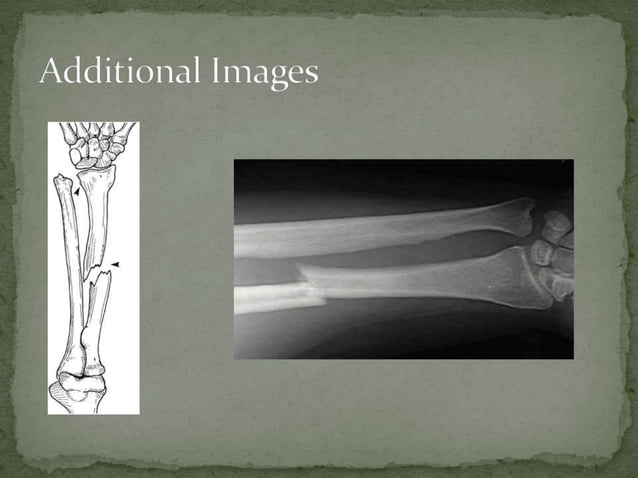 Galeazzi fracture (1) | PPTX