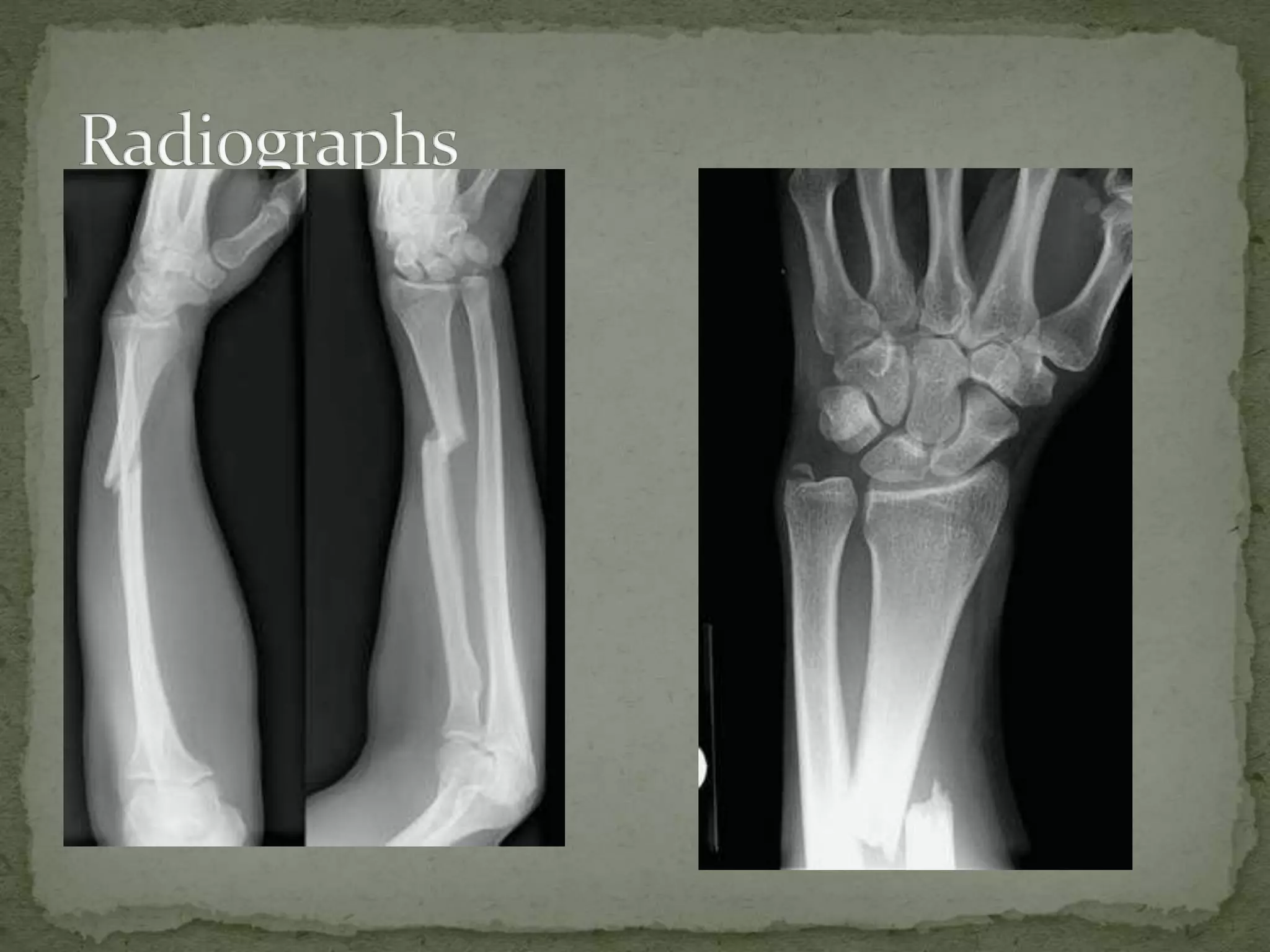Galeazzi fracture Power Point | PPTX