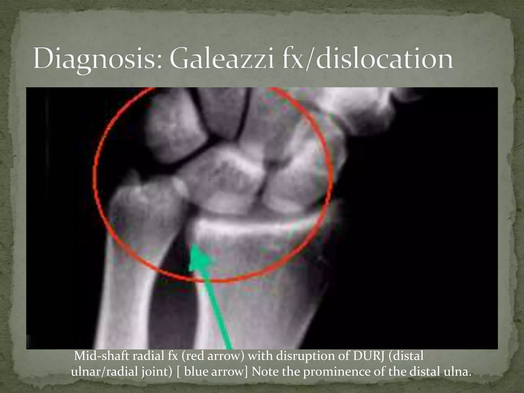 Galeazzi fracture Power Point | PPTX