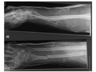 Galeazzi fracture 2019 | PPT