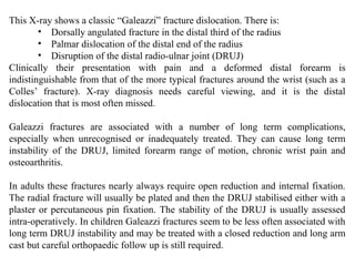 Galeazzi fracture 2019 | PPT