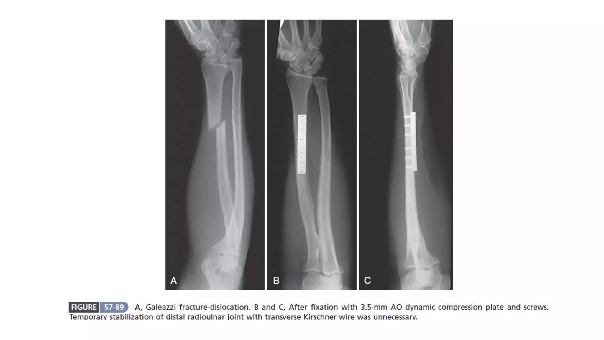 Galeazzi fracture dislocation | PPTX