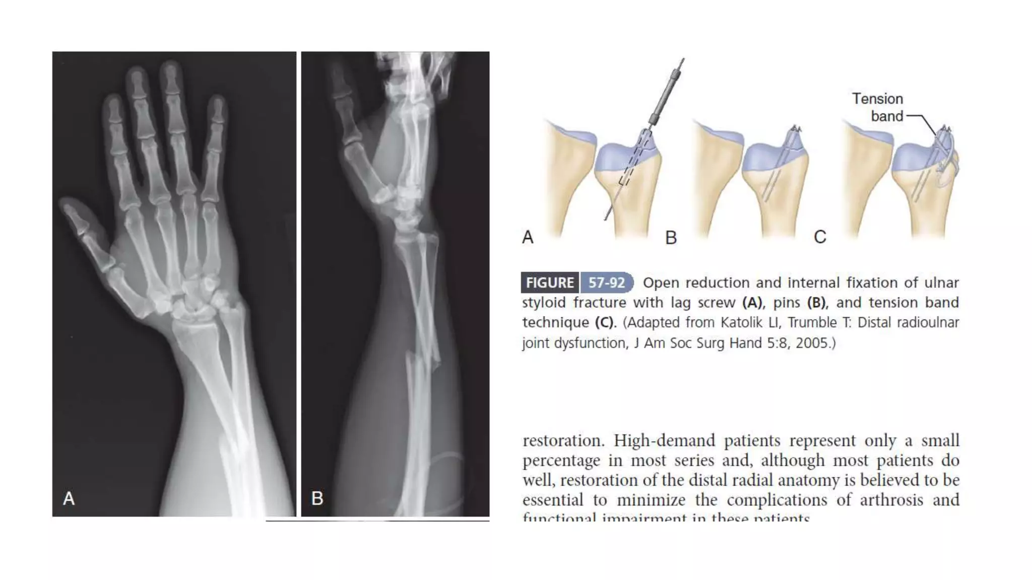 Galeazzi fracture dislocation | PPTX