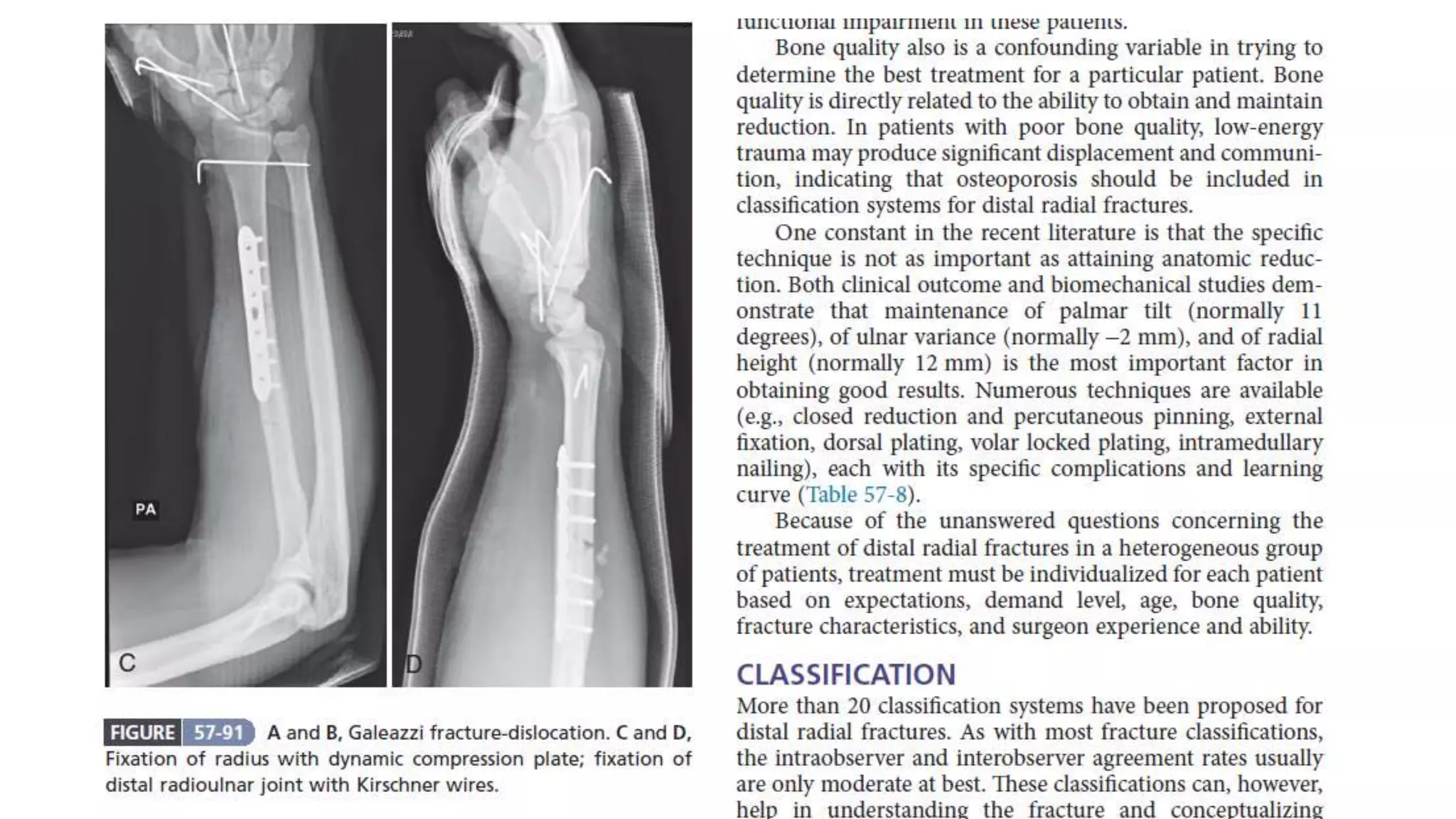 Galeazzi fracture dislocation | PPTX