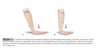 Galeazzi fracture dislocation | PPTX