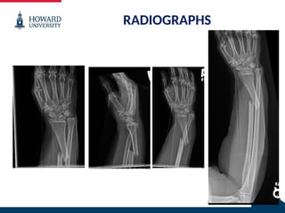 Galeazzi Fracture Overview and Case Example | PPTX