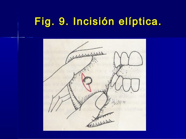 Galería de imágenes cirugia bucal tema 1