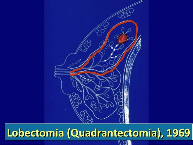Quadrantectomia- Bls