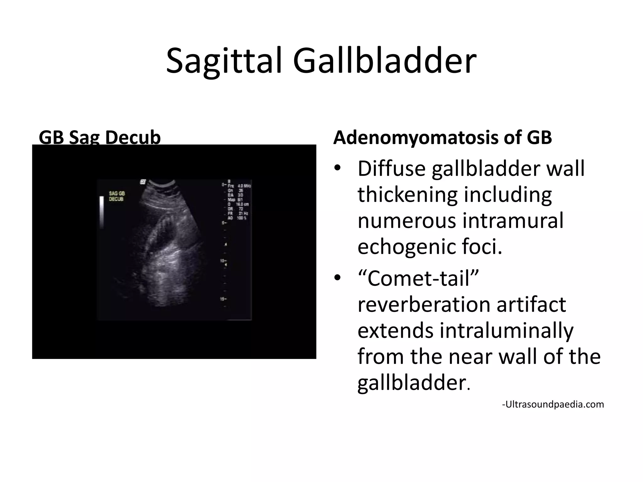 Gallbladder | PPTX