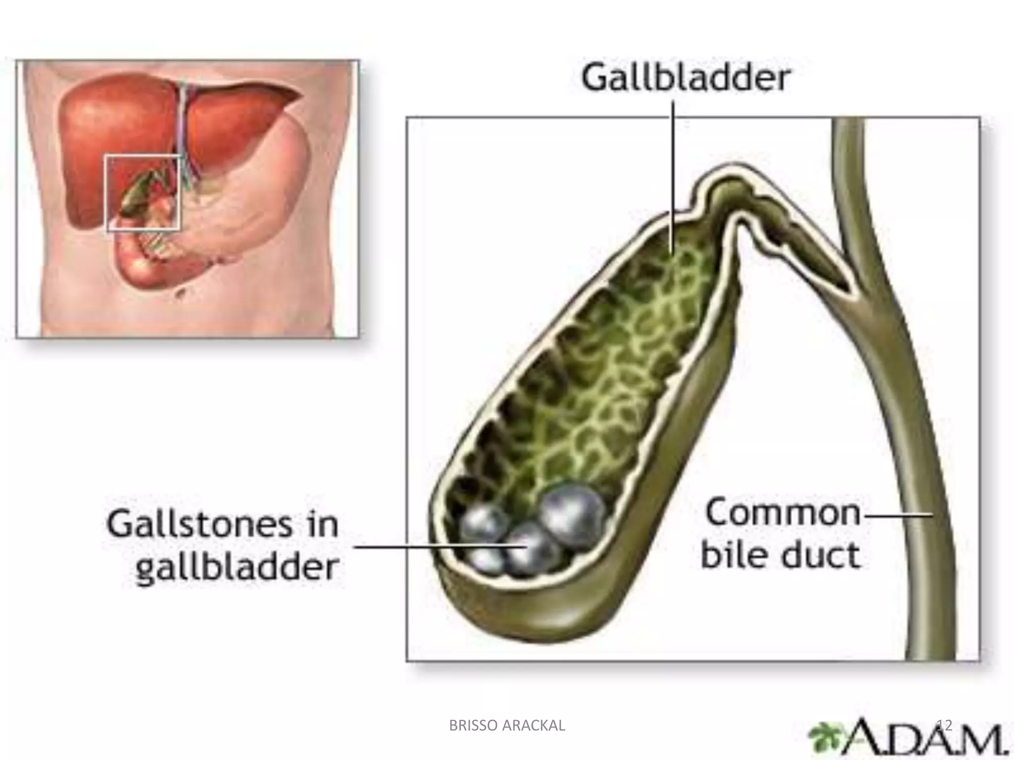 Gall bladder | PPTX