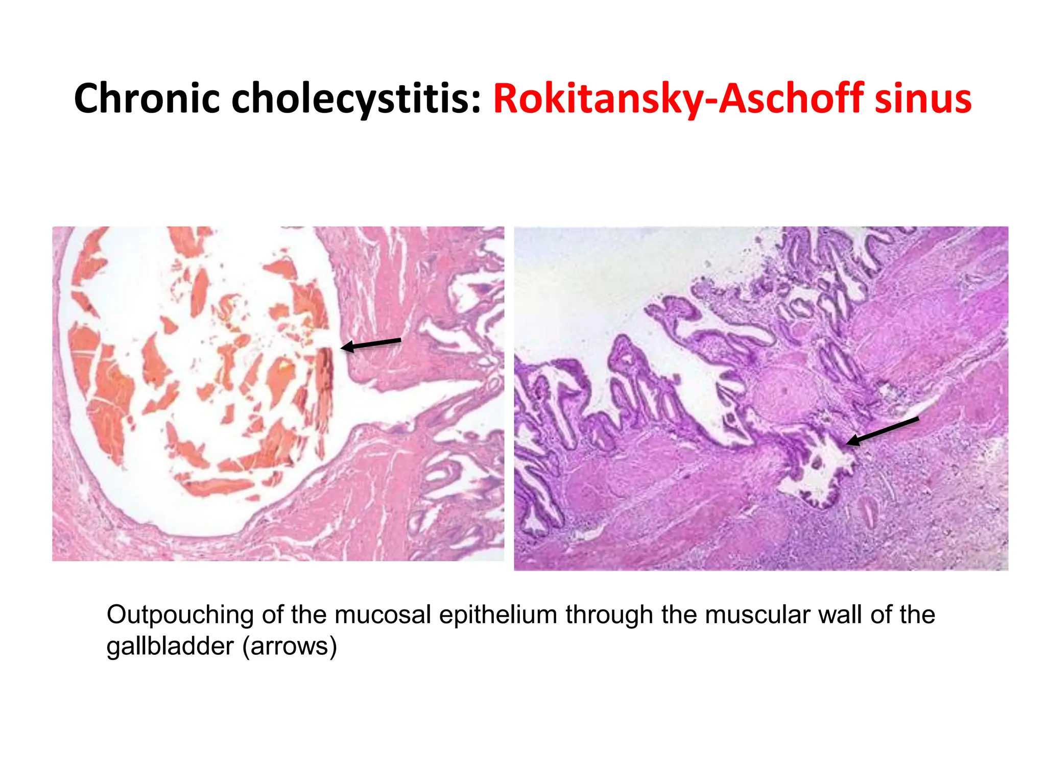 GALL BLADDER from medicine pathology course | PPT