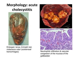 GALL BLADDER from medicine pathology course | PPT