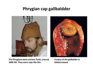 GALL BLADDER from medicine pathology course | PPT