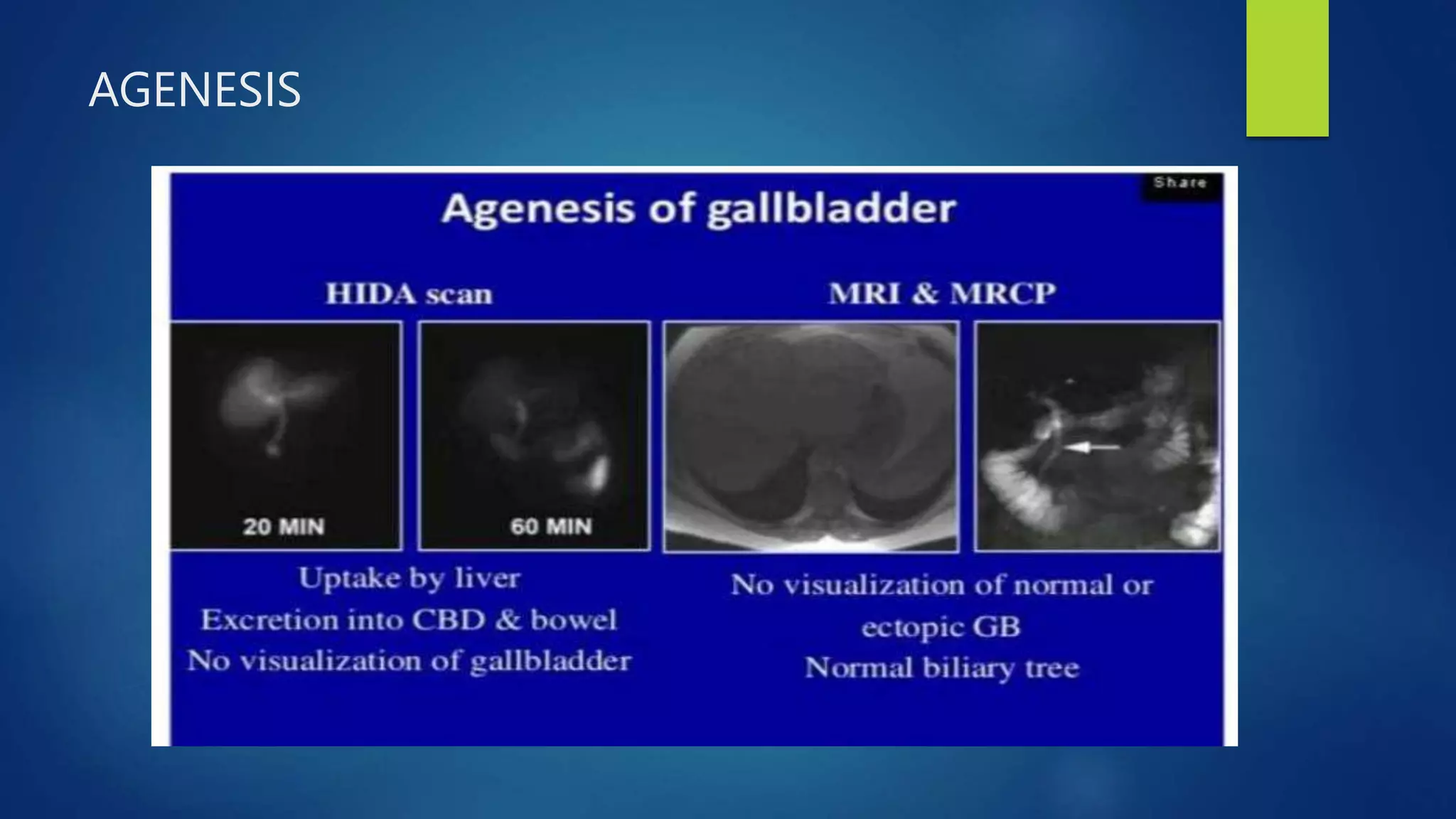 GALL BLADDER ^0 BILIARY PATHOLOGY.pptx