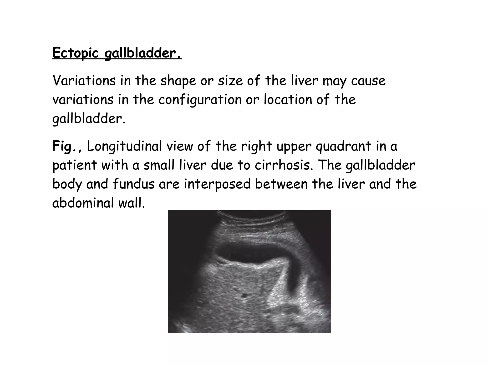 Gall bladder Ultrasound | PPT