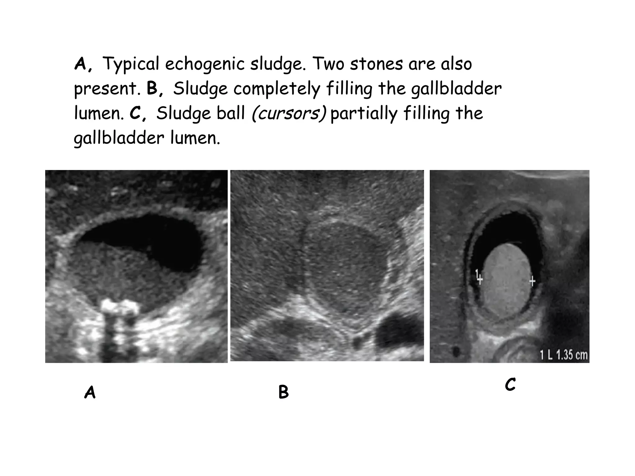 Gall bladder Ultrasound | PPT