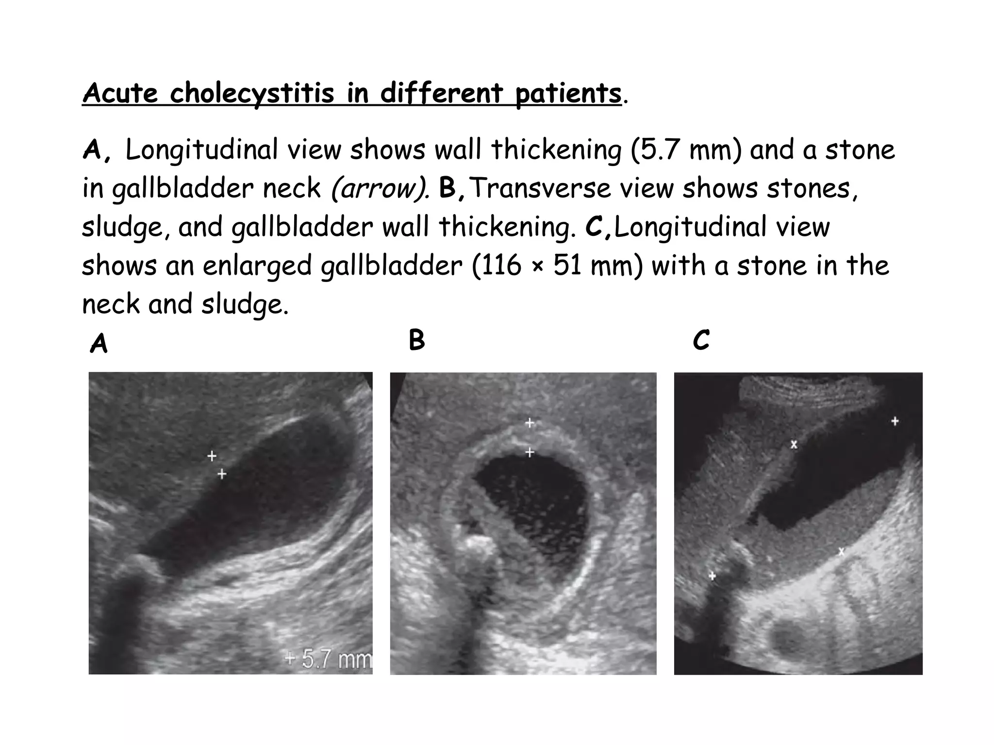 Gall bladder Ultrasound | PPT