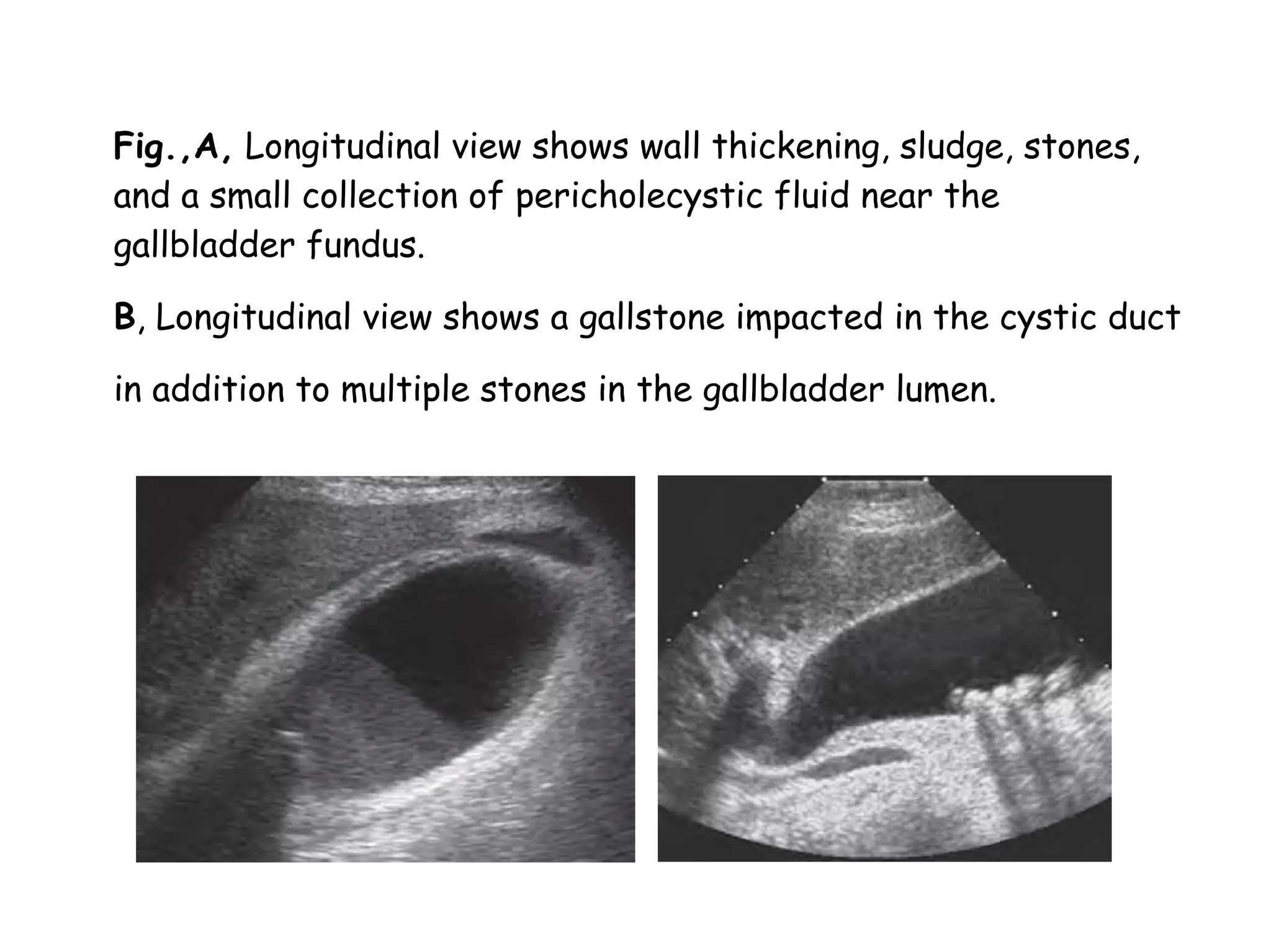 Gall bladder Ultrasound | PPT