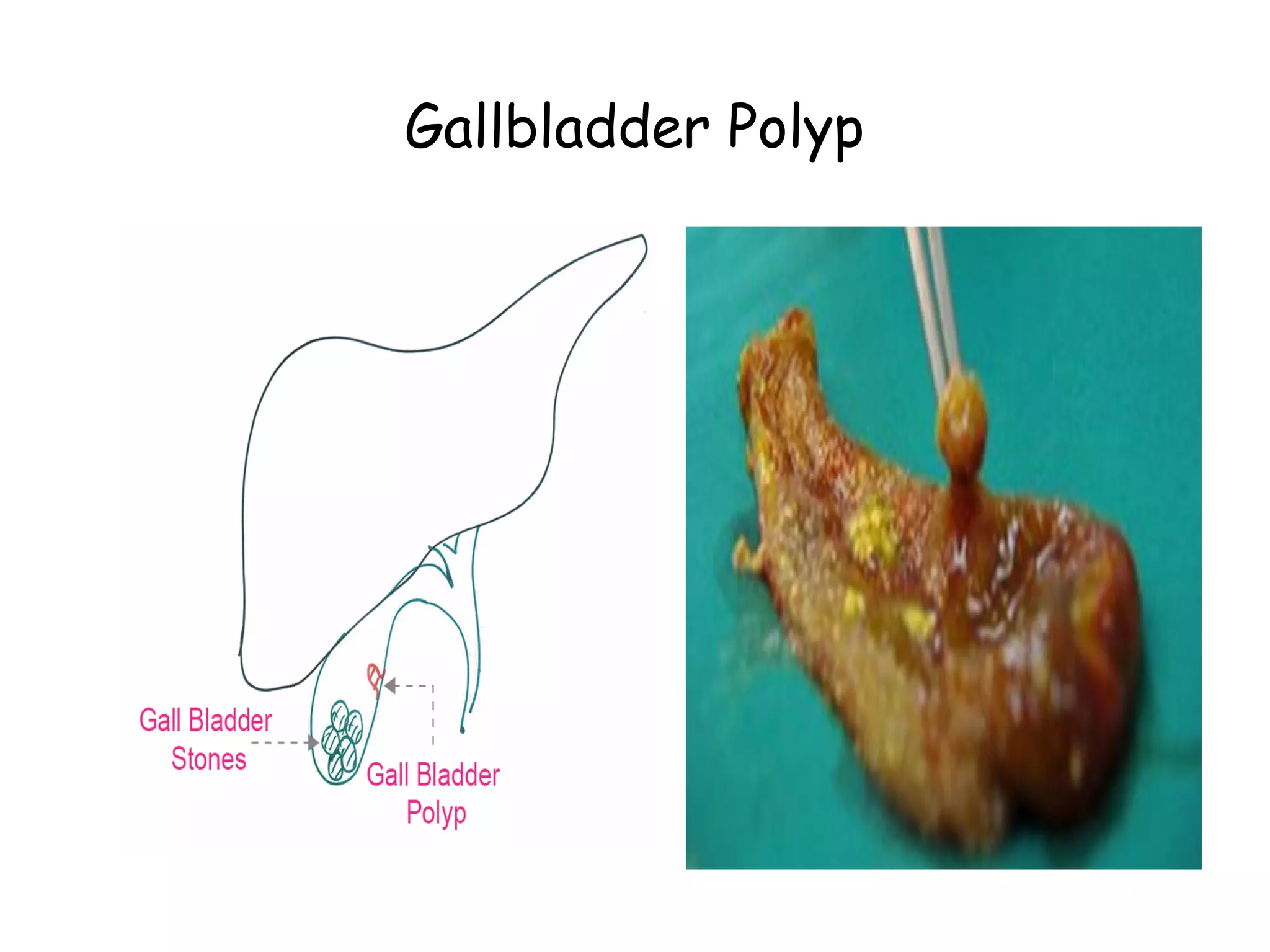 Gall bladder Ultrasound | PPT