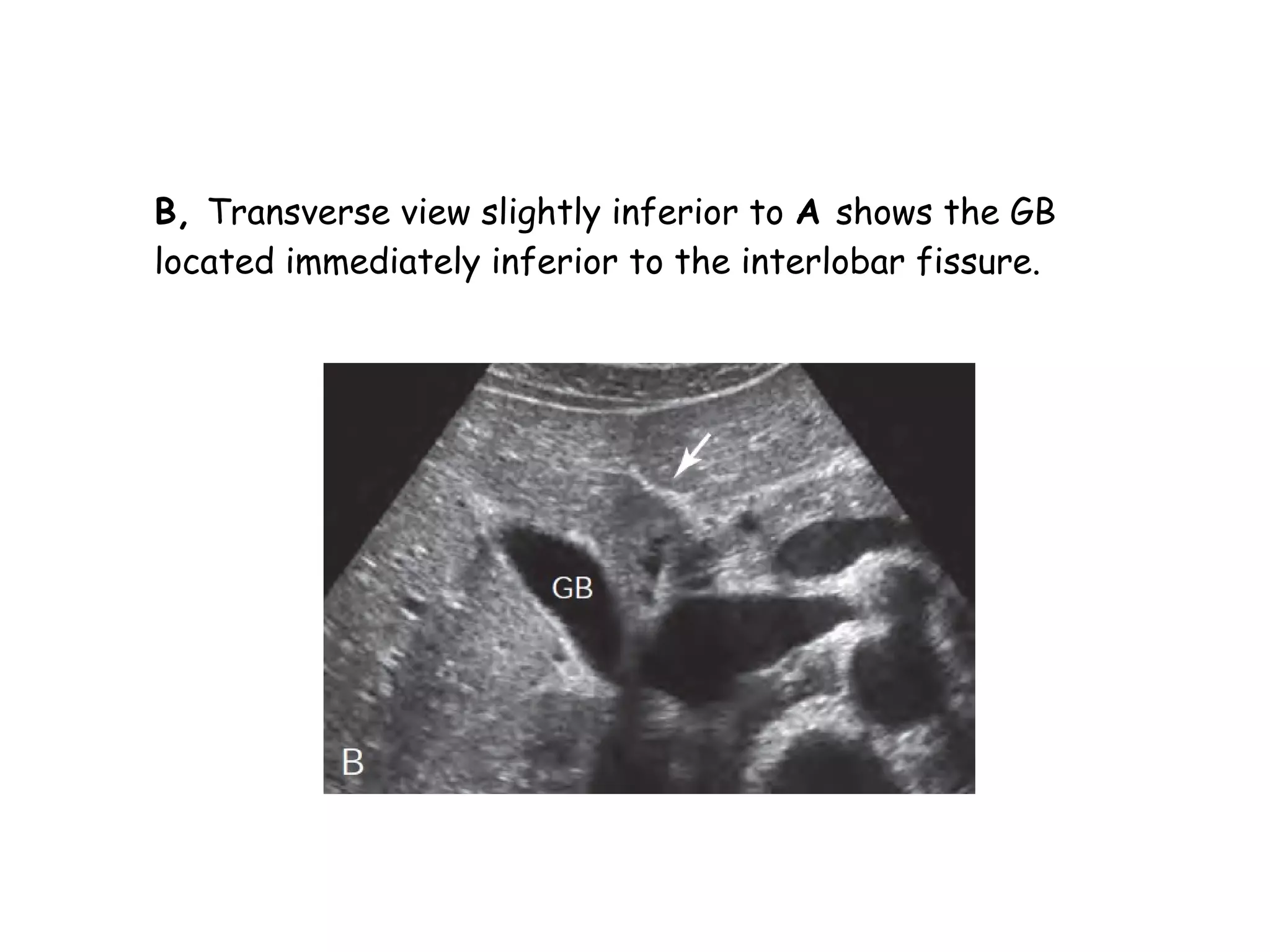 Gall bladder Ultrasound | PPT