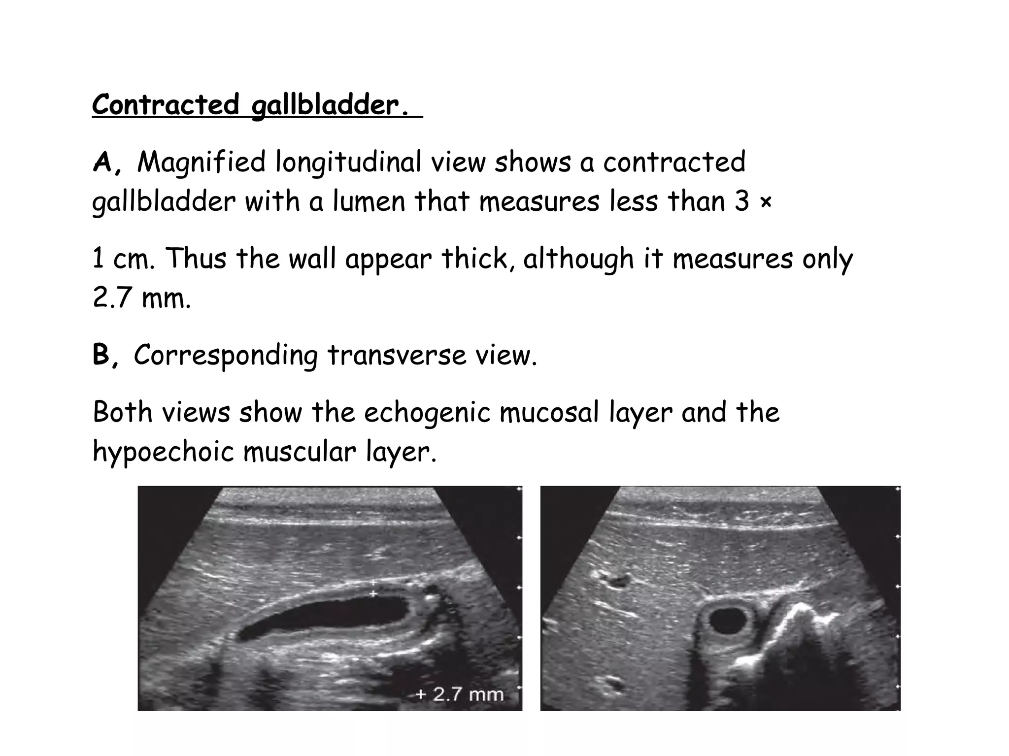Gall bladder Ultrasound | PPT