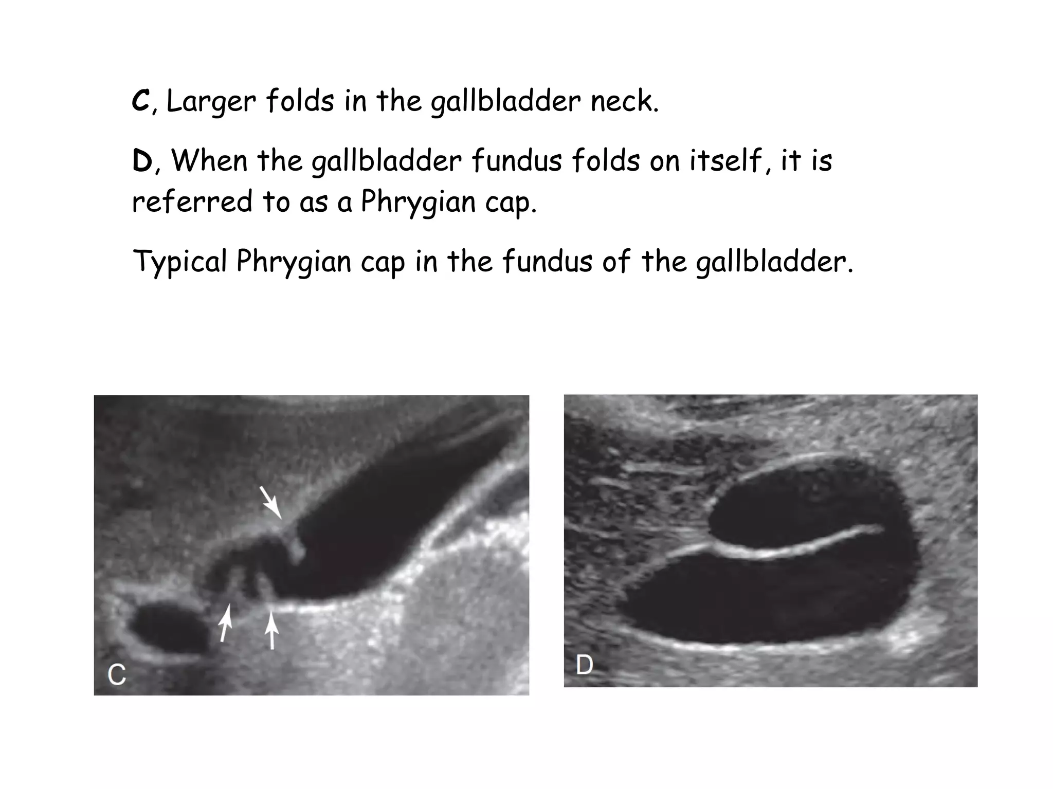 Gall bladder Ultrasound | PPT