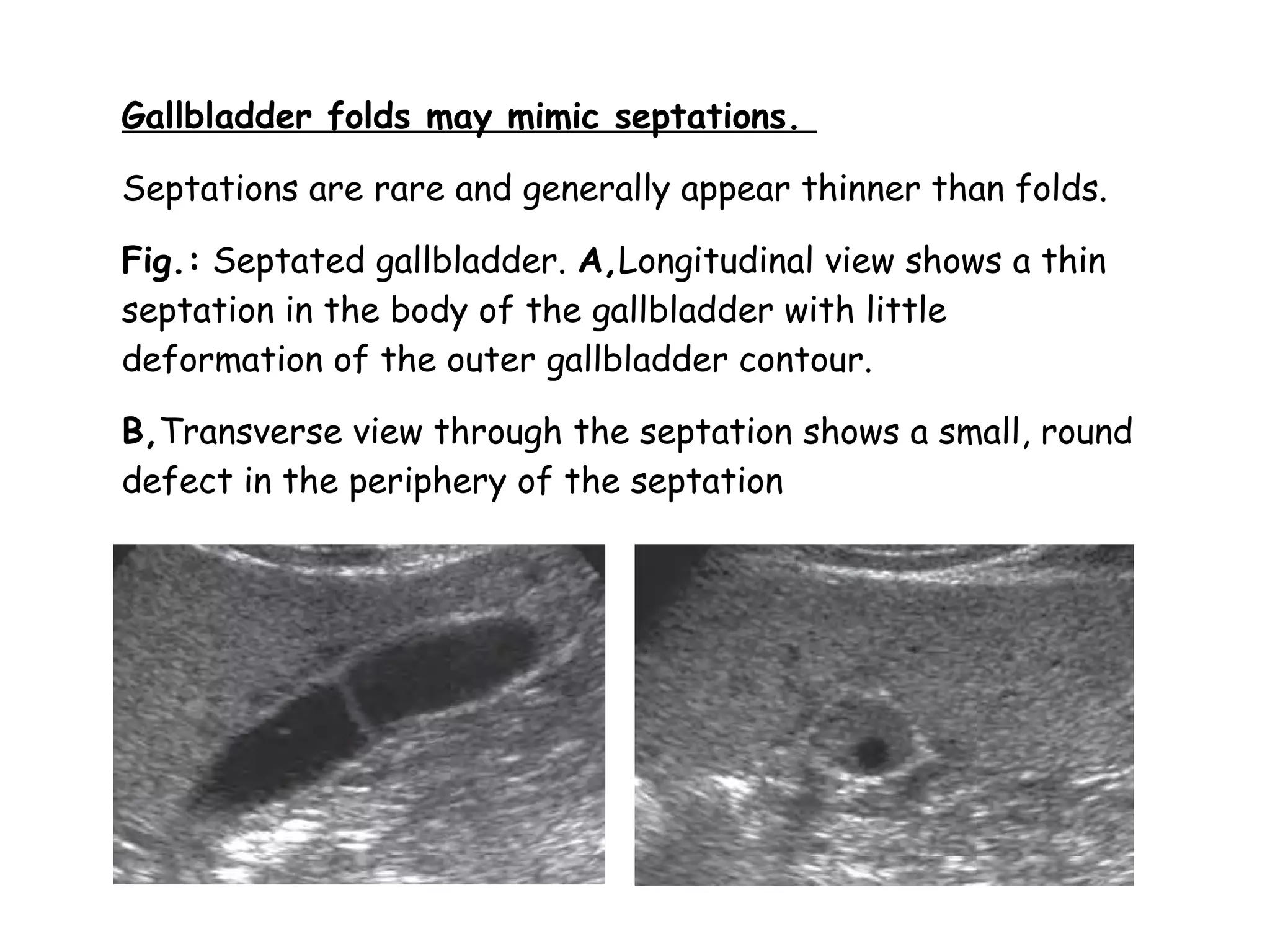 Gall bladder Ultrasound | PPT