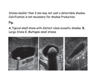 Gall bladder Ultrasound | PPT