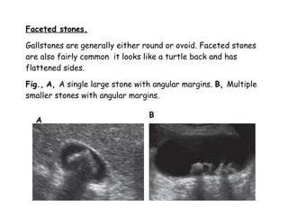 Gall bladder Ultrasound | PPT
