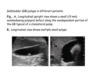 Gall bladder Ultrasound | PPT