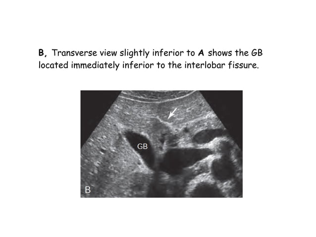Gall bladder Ultrasound | PPT | Pregnancy | Reproductive Health