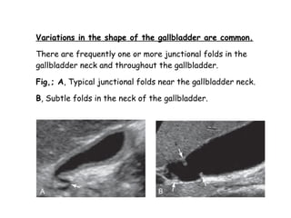Gall bladder Ultrasound | PPT