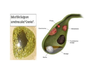 Gallbladder Sludge