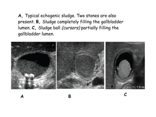 Gallbladder Ultrasound Sludge