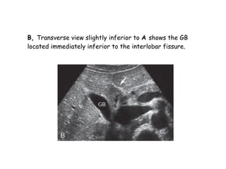 Gallbladder Ultrasound Transverse