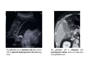 Gall bladder and biliary pathologies.pptx
