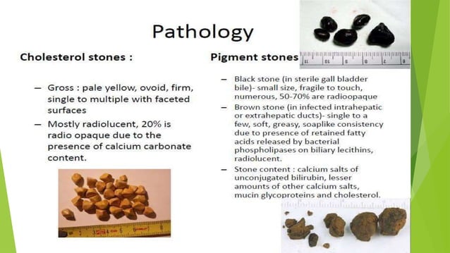 Gallbladder benign conditions | PPTX