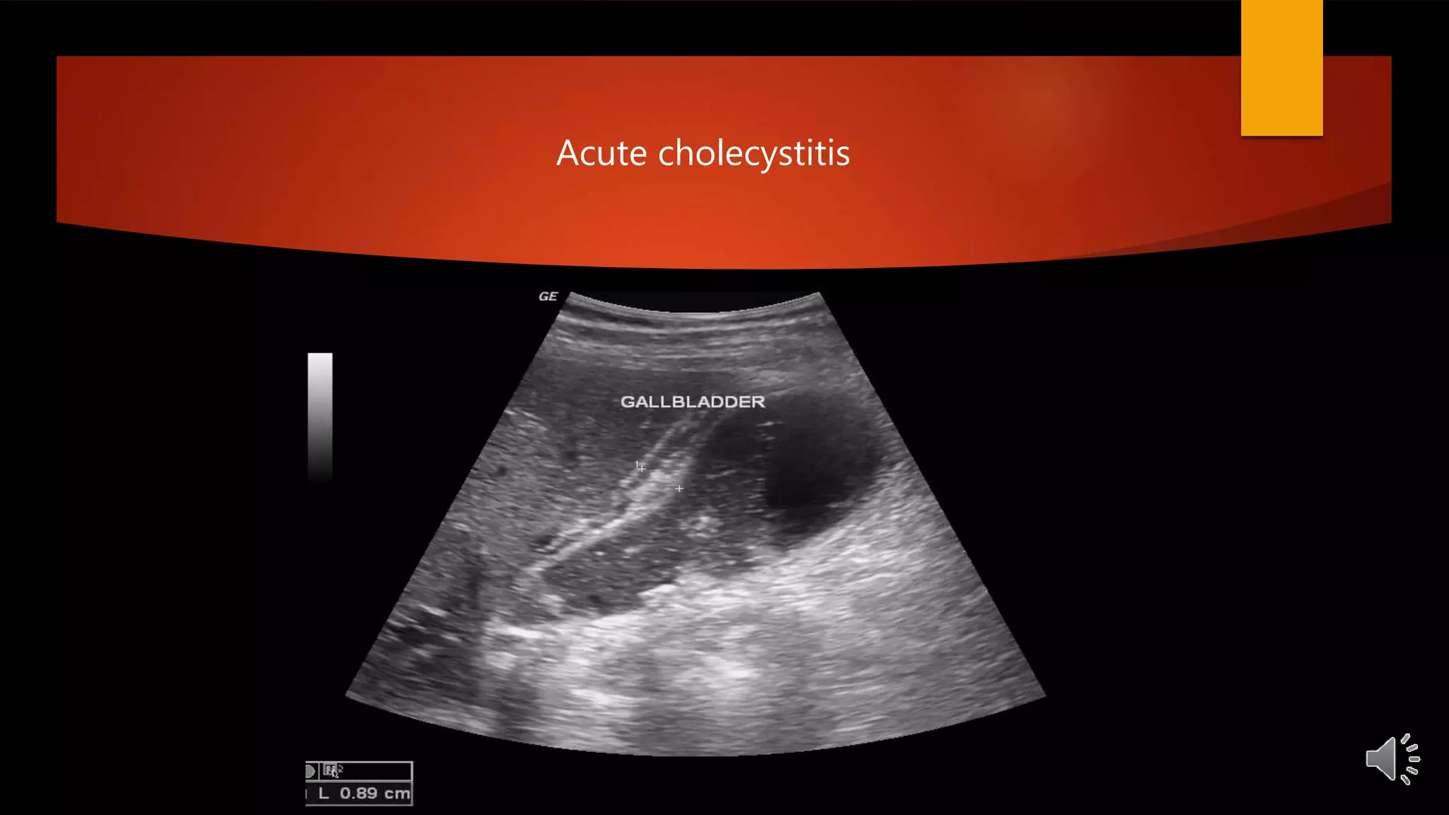 Gall bladder & bile ducts with narration | PPTX