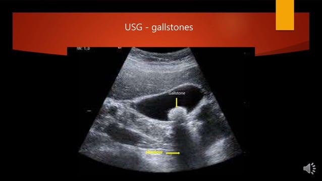 Gall bladder & bile ducts with narration | PPT