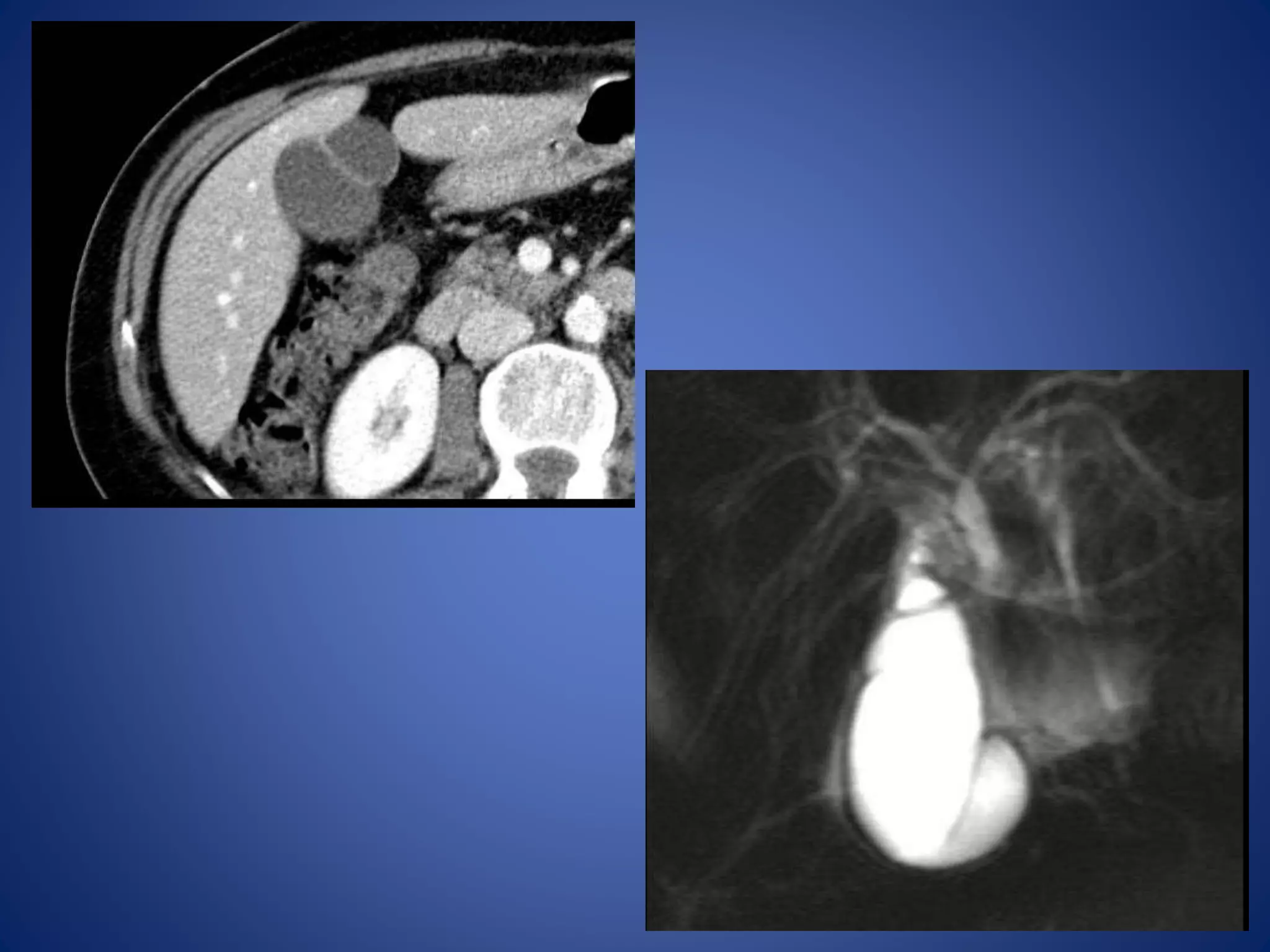Gall bladder & biliary tract anomalies and variants | PPTX