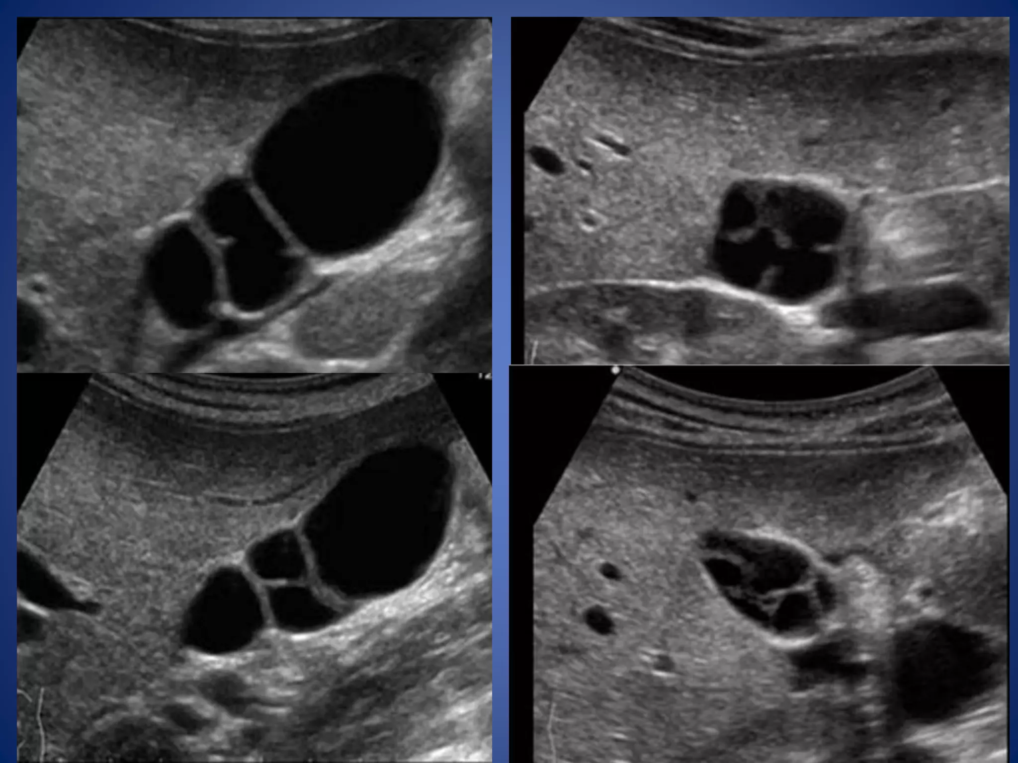 Gall bladder & biliary tract anomalies and variants | PPTX