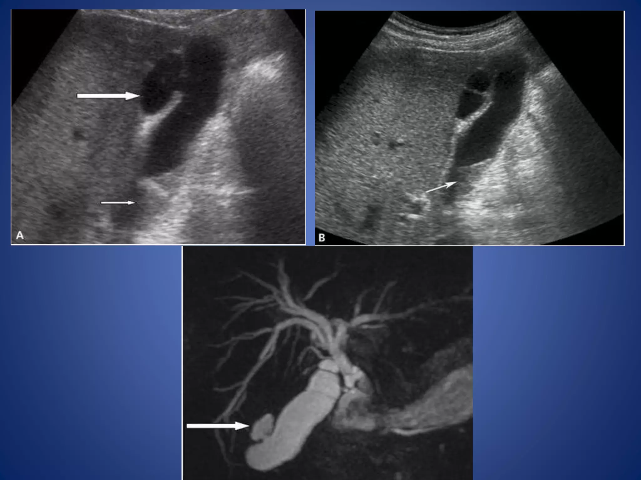 Gall bladder & biliary tract anomalies and variants | PPTX