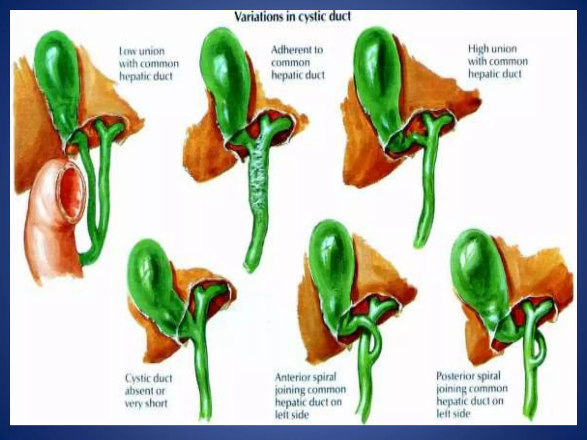 Gall bladder & biliary tract anomalies and variants | PPTX