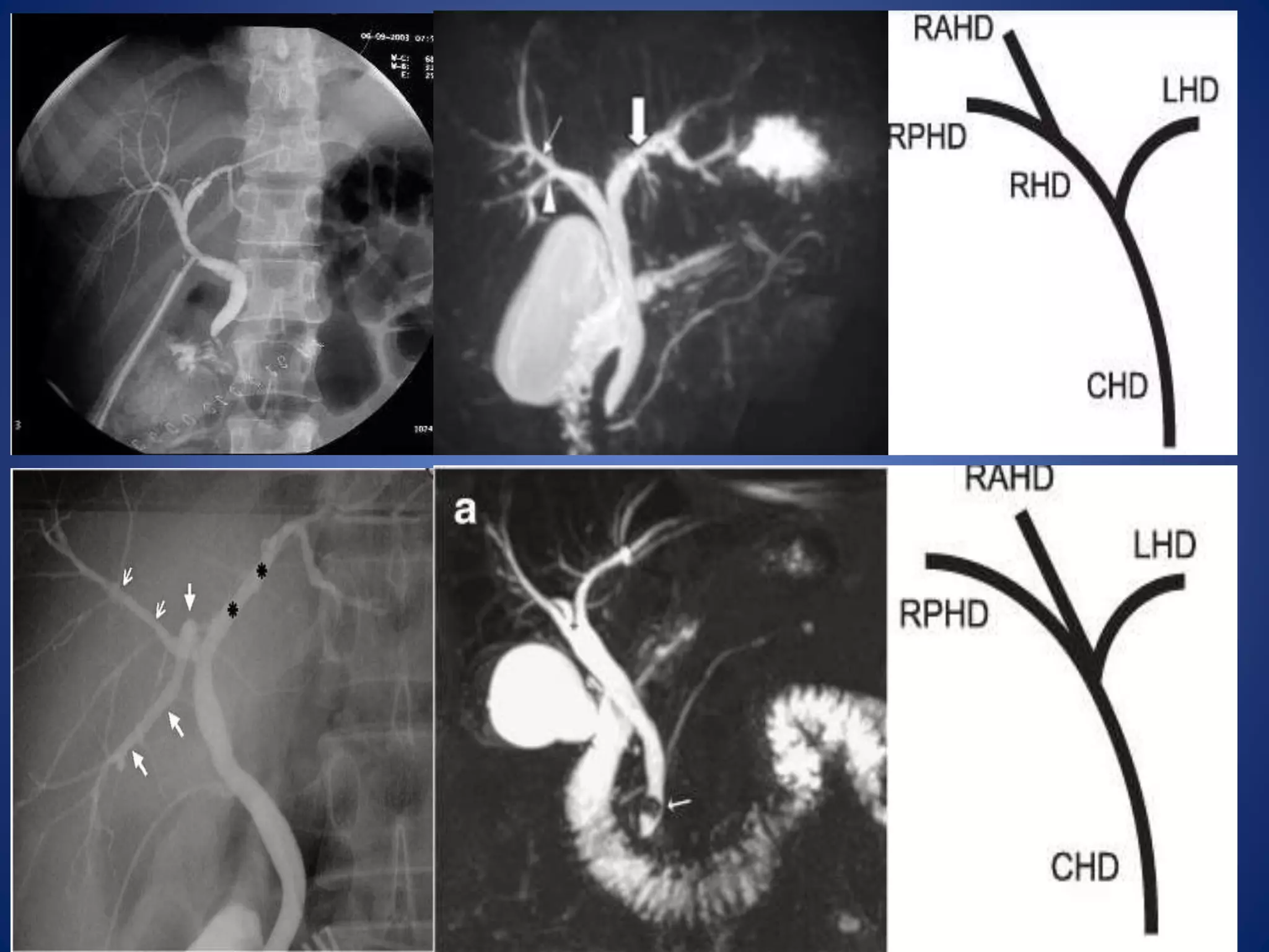 Gall bladder & biliary tract anomalies and variants | PPTX
